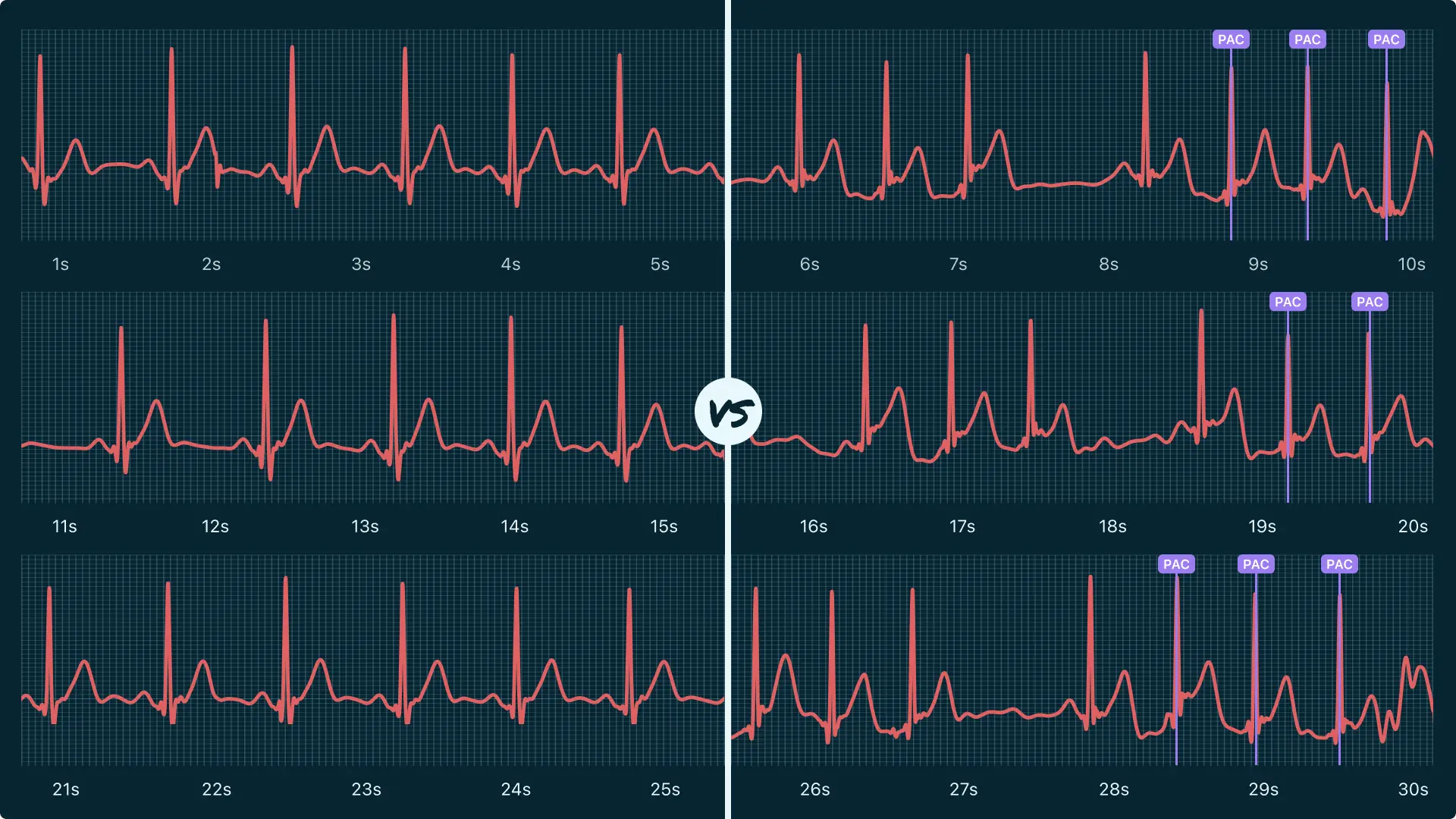 Normal Sinus Ekg What Defines A True Normal Sinus Rhythm On A 12 Lead